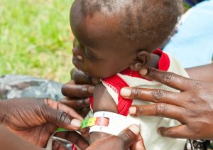 Malnutrition Definition | Valid Nutrition